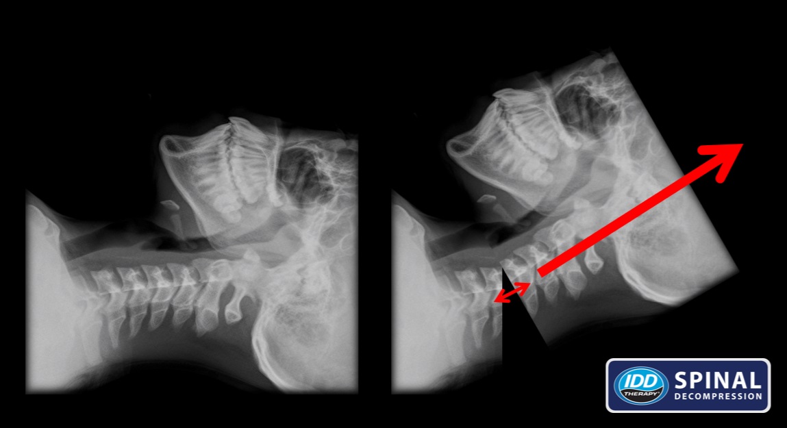 Cervical Spinal Decompression NON SURGICAL SPINAL DECOMPRESSION IN